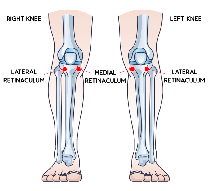 Donjoy OA Nano Unloader OA Knee Brace - KneeSupports.com